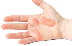 ISPUCALE RUKE (svi razlozi zbog kojih se javlja ispucala koža na ...