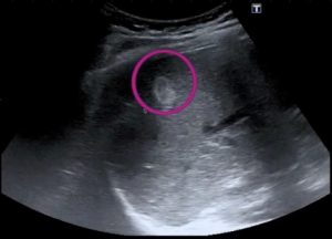 Lezije na jetri (uzrok i lečenje) – Simptomi bolesti